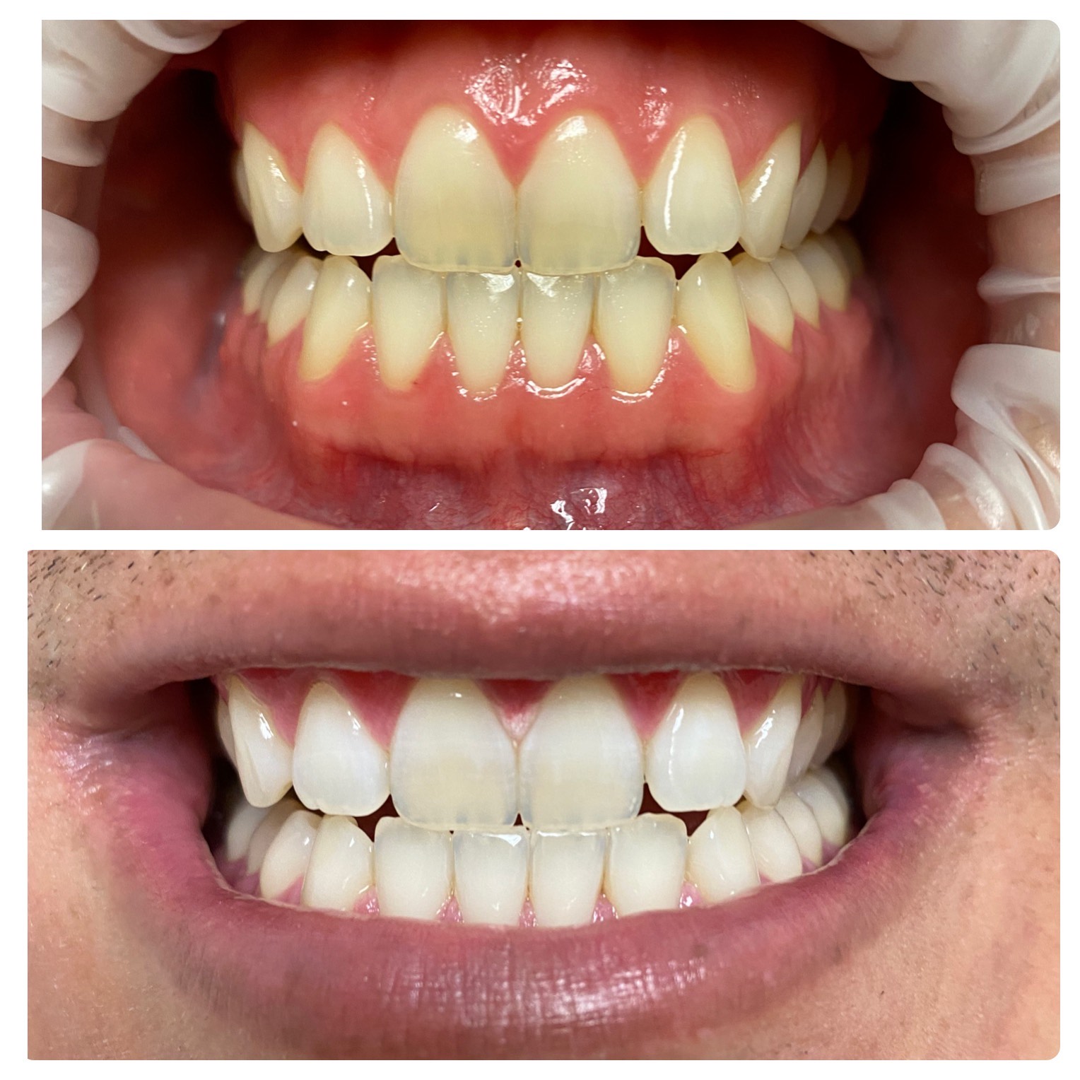 Teeth Whitening Services Orange CA - LIONESS GLOW SPRAY TANS